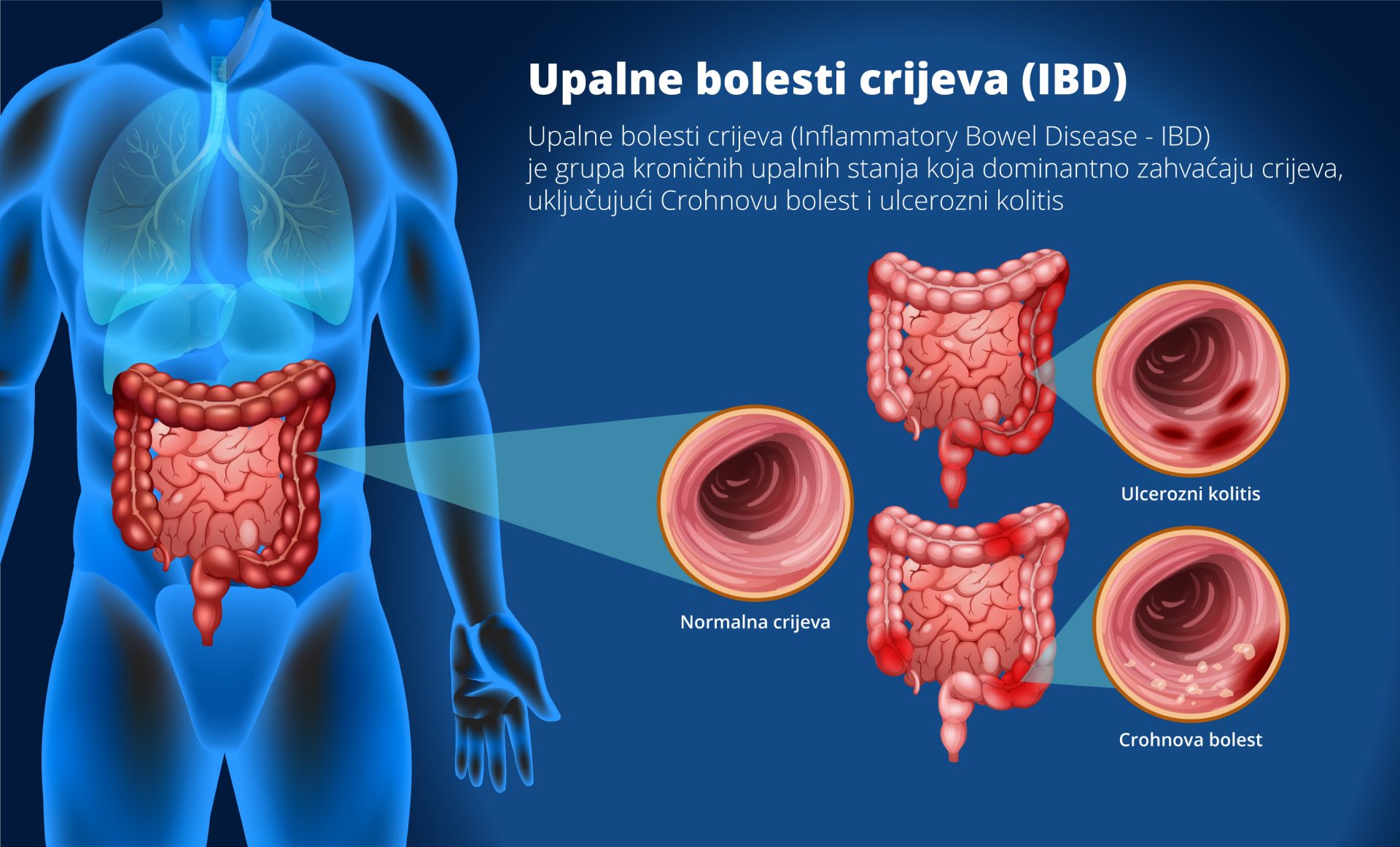 Crohnova bolest i ulcerozni kolitis – individualni pristup od dijagnoze ...